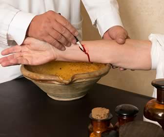 Bloodletting: *Is This Archaic Practice Still Being Used? | allnurses